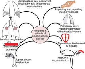 Neuromuscular Disorders and Biphasic Cuirass Ventilation (BCV) - Hayek ...
